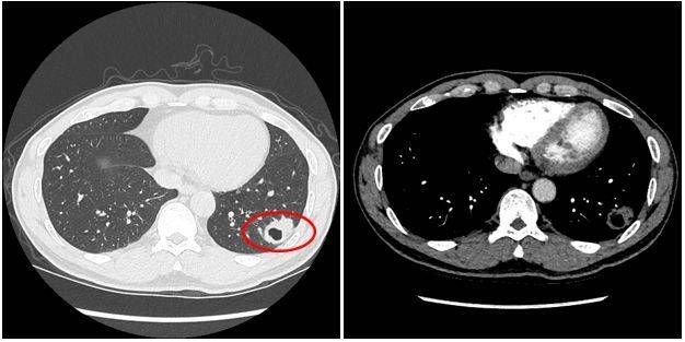 8分钟看懂呼吸介入前沿技术——EBUS-TBNA临床操作详解_南方plus_南方+